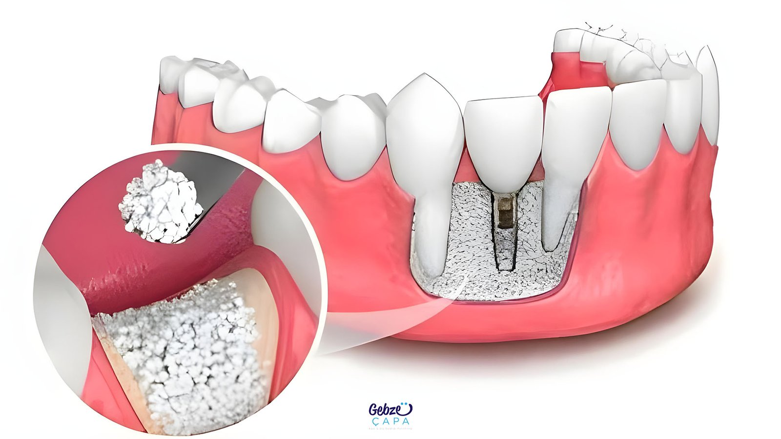 Bone Powder Surgery - Gebze Çapa ADSP 2025