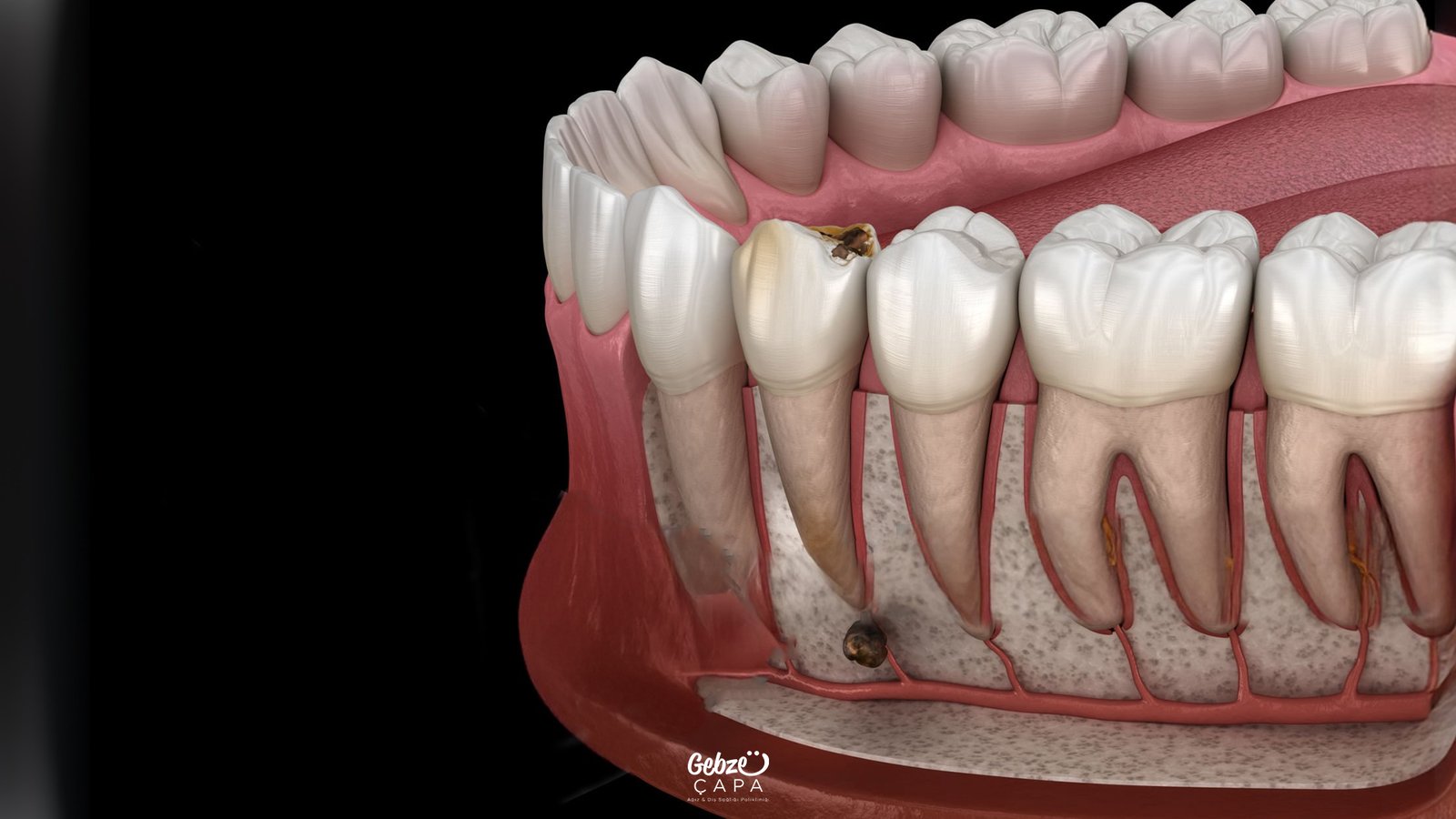 Apikal Rezeksiyon Nedir? - Gebze Çapa ADSP 2025
